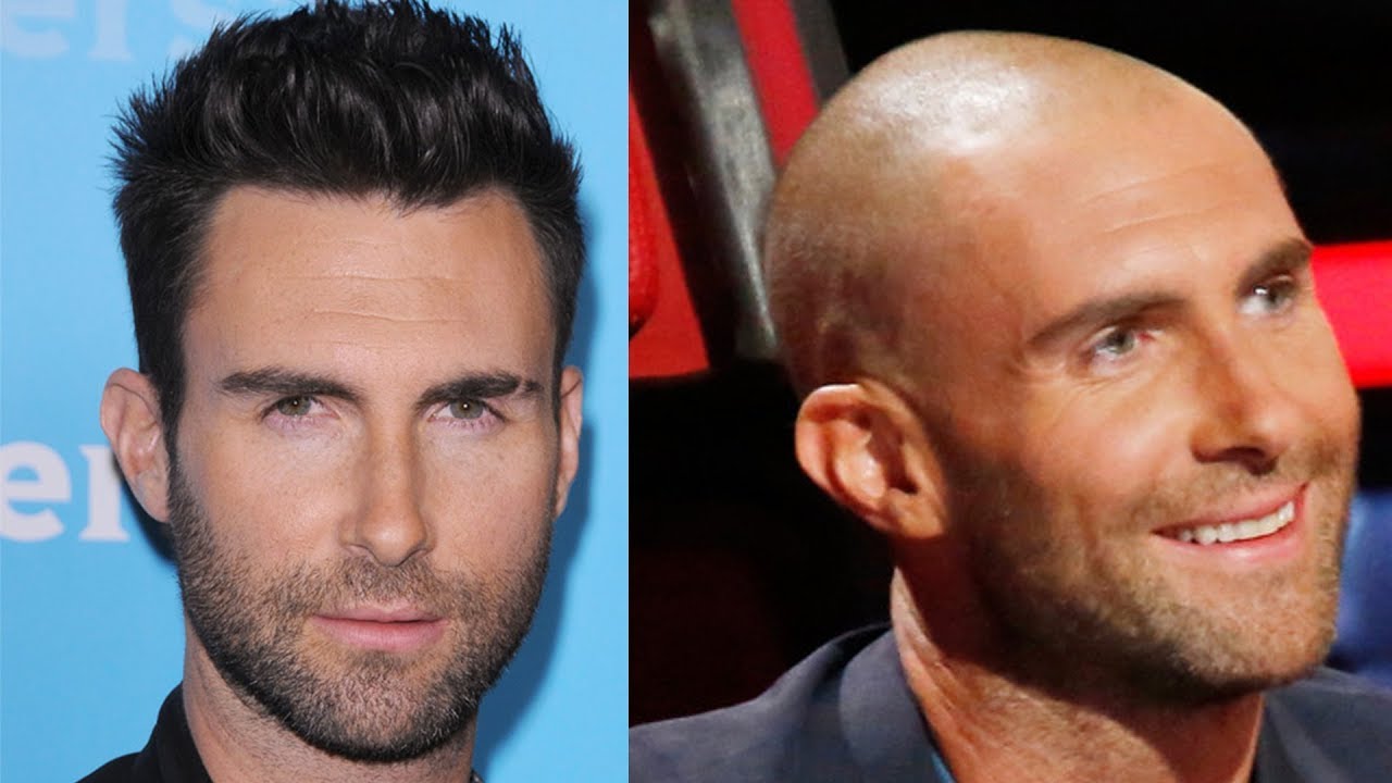 Celebrities And Hair Transplants A Best Fashion